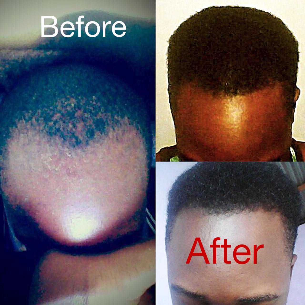 detumescence therapy – Regrow Your Hair Naturally